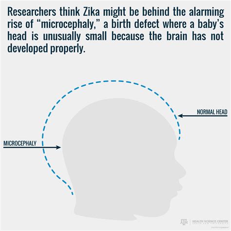 Microcephaly And Zika1024x1024 Vital Record