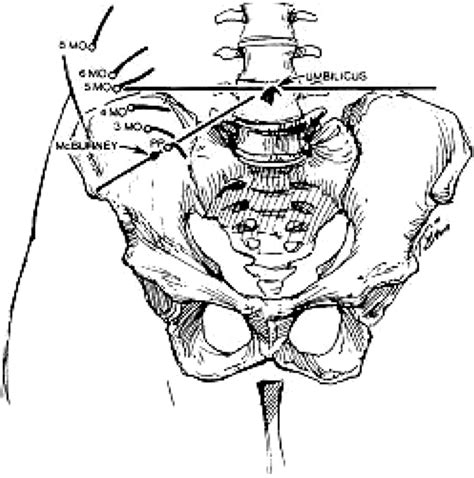 Changes In Position Of The Appendix As Pregnancy Advances MO Month Download Scientific