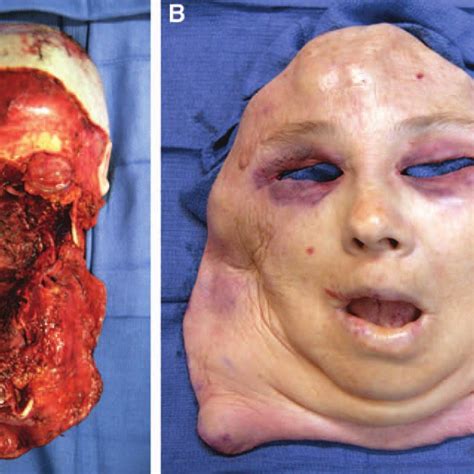 Allograft Preparation A And The Full Facial Allograft With Preserved Download Scientific
