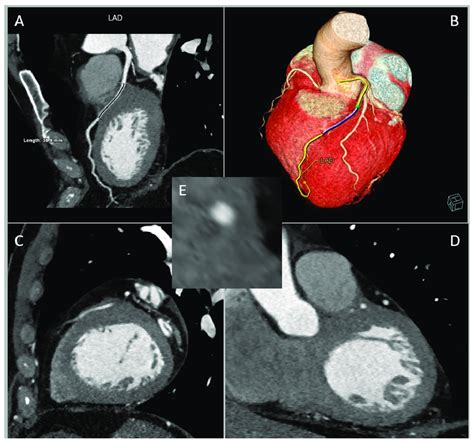 Long Myocardial Bridging Mb Of Left Anterior Descending Artery Lad