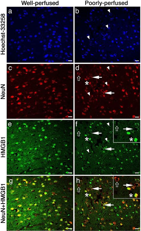 Dysmorphic Neurons Were Stressed And Released Hmgb1 During Poor