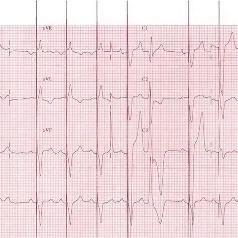 Pdf A Case Of Twitching On The Pacemaker Pocket