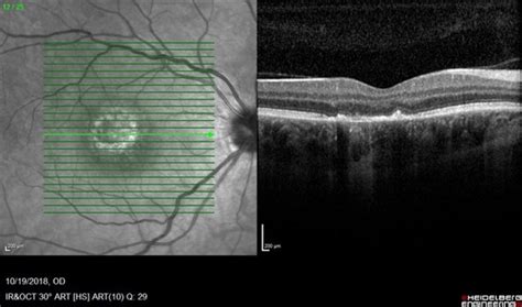 Unilateral Acute Idiopathic Maculopathy Oct Macula Retina Image Bank