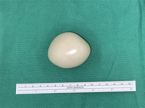 病人開刀取出「巨大舍利子」！醫師驚曝真相：消化外科最常遇到 祝你健康 三立新聞網 Health Setn Com