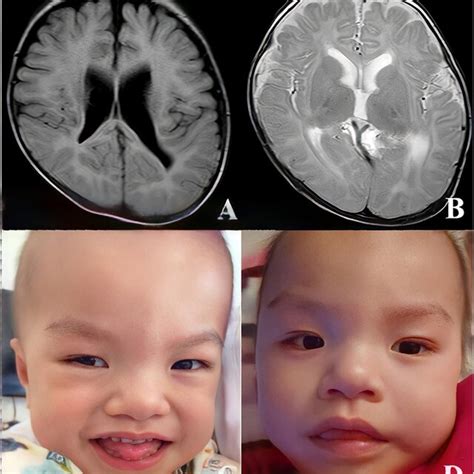 Head Mri Findings And Photographs Of The Dysmorphic Features Axial Download Scientific Diagram