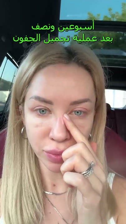 نتائج عملية رأب الجفن العلوي Youtube