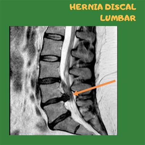 Hernia Discal Cómo Tratarla Con Fisioterapia Pcetsk