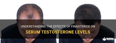 Understanding The Effects Of Finasteride On Serum Testosterone Levels