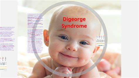 Digeorge Syndrome Facial Features
