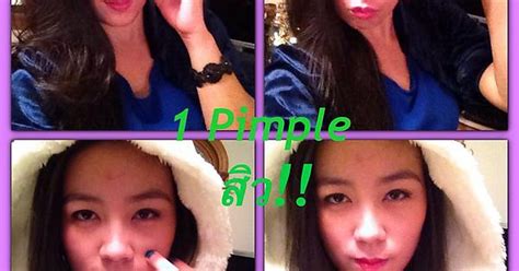 1 Pimple Imgur