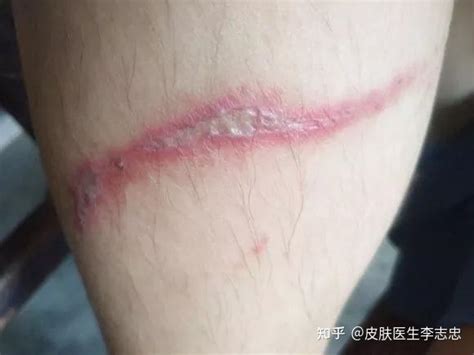 什么是隐翅虫皮炎？怎么治疗隐翅虫皮炎？ 知乎