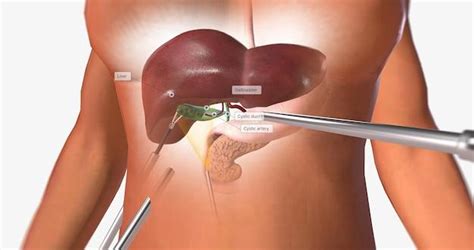 What Body Cavity Is Opened For Gallbladder Removal Ap Pgecet