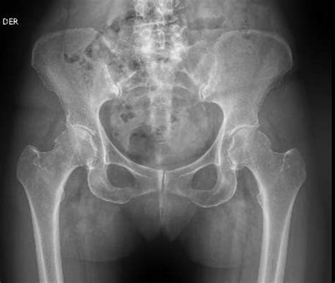 Esteban Holguin On Linkedin Simultaneous Total Hip Replacement