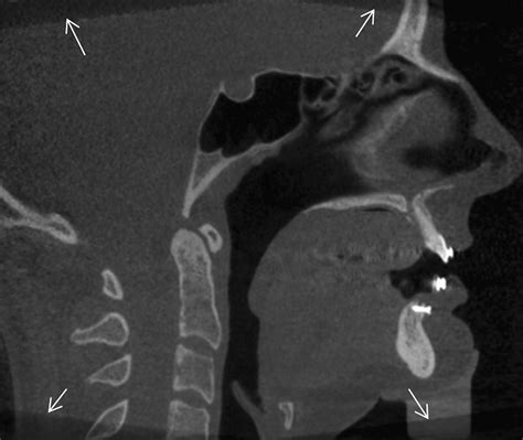 Cone Beam Artifact In Ct The Best Picture Of Beam