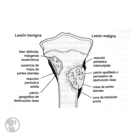 Lesión ósea De Características Tumorales ¿cómo Actuar Awaredoctor
