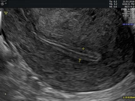 Impressive Info About How To Improve Endometrium Thickness Settingprint