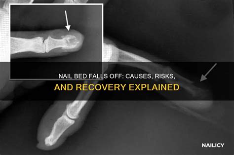 Nail Bed Falls Off Causes Risks And Recovery Explained Nailicy