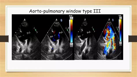 Aorto Pulmonary Window May 2021 Pdf