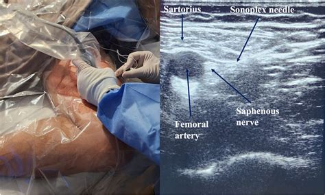 Adductor Canal Blocks May Result In Long Term Neuropathy After Total