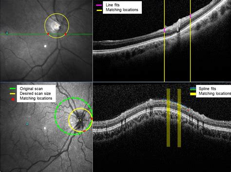 Manual Measurement Of Misaligned Oct Scans