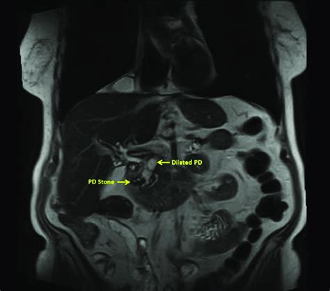 Pancreatic Divisum Radiology