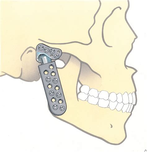 Biomaterials In Temporomandibular Joint Replacement Current Status And