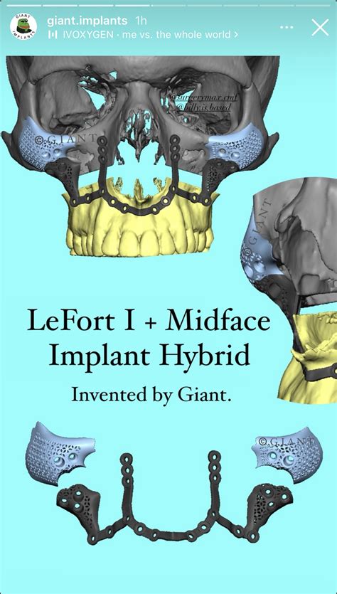 Clavicular Surgery Plan Mens Self Improvement