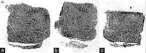 Dermatoglyphics Definition Uses Causes Of Abnormal Dermatoglyphics