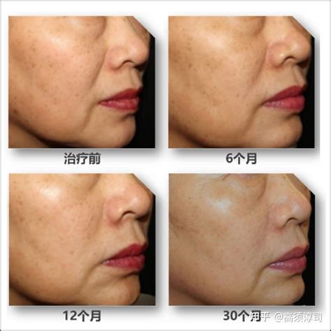 国内首款拥有nmpa 批准的艾维岚 童颜针”，究竟怎么样？ 知乎