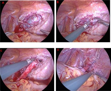 Transabdominal Approach Laparoscopic Ureteral Reimplantation At The Top