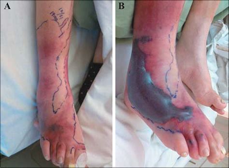 Necrotizing Fasciitis Progression