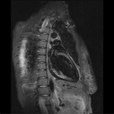 Cardiac Mri T2 Weighted Stir Sequence Long Axis View Showing An