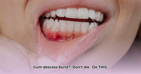 Can Popping A Gum Abscess Kill You Dangers And What To Do Chaztin