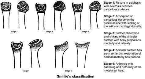 Freibergs Infraction Avascular Necrosis Of The 2nd Metatarsal