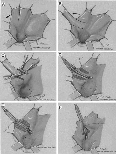 Vesicostomy
