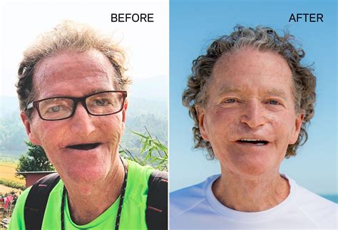 Jaw In A Day Surgery Restores Squamous Cell Carcinoma Survivors Face Northwell Health