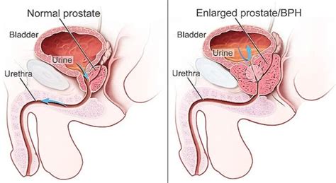 Diagram Of Enlarged Prostate