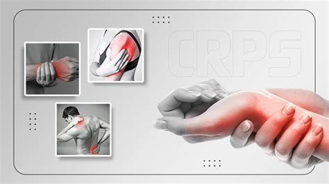 Everything You Need To Know About Crps