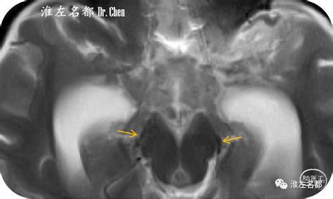 神经血管影像速阅74：感染性血管炎—儿童结核性脑膜炎和双侧豆纹动脉梗死 脑医汇 神外资讯 神介资讯