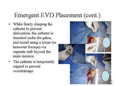 Surgical Protocol For External Ventricular Catheter Evd Placement