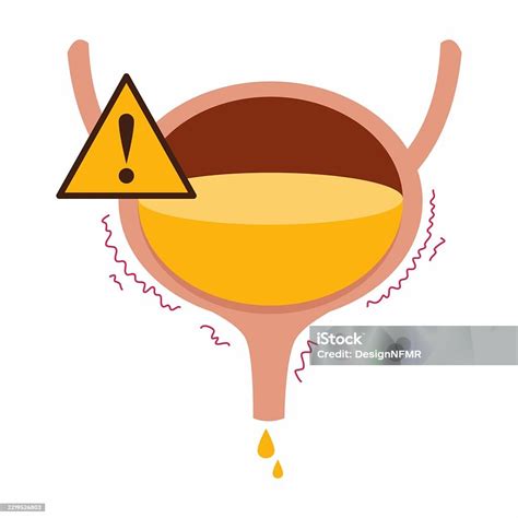 Urinary Incontinence Illustration Overactive Bladder Urinary Tract