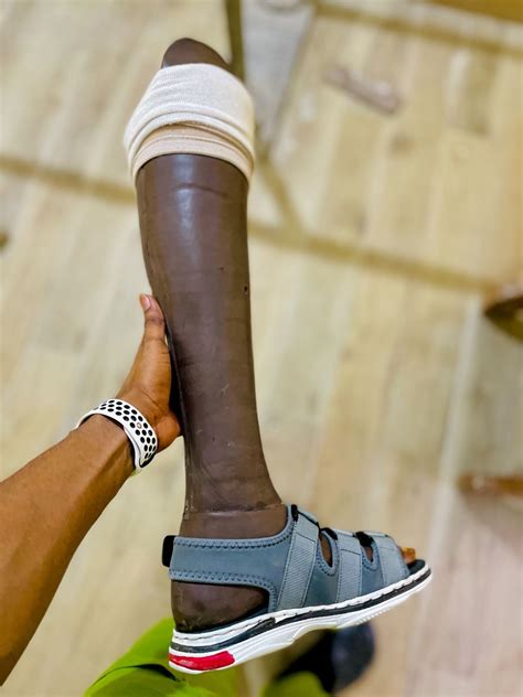 Michael Gyamfi On Linkedin A Finished Transtibial Prosthesis With An