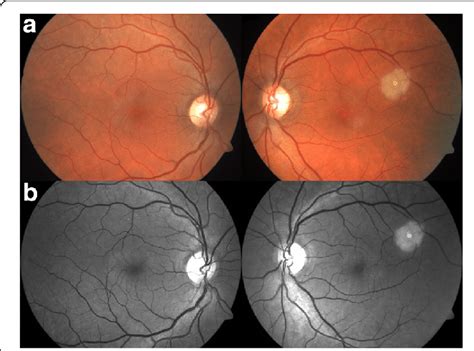 Colour Fundus Photography A Whitish Tumour With Calcification At The