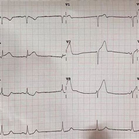 Electrocardiogram Showing St Elevation In Anterior Leads Download