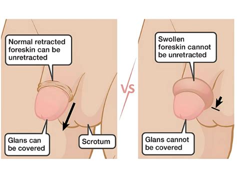 Best Swollen Penis Treatment In Karimnagar Expert Treatment At Kk