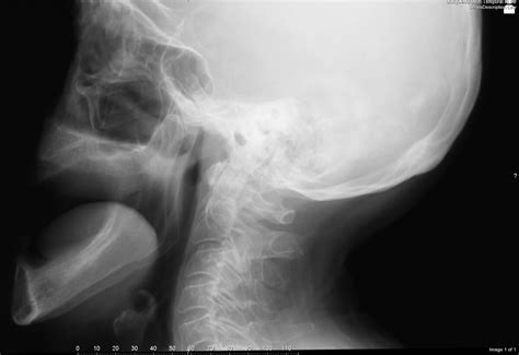 Radiopaedia Case Temporomandibular Joint Dislocation Id 83315 Study