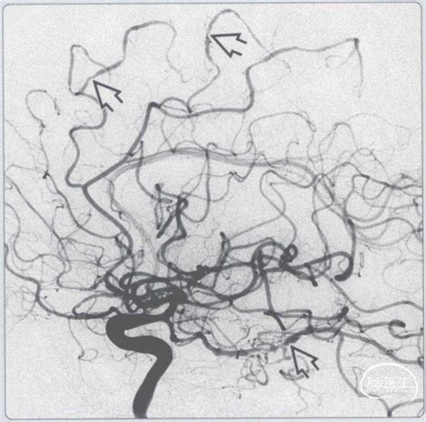 【影像时间·94】一位继发性中枢神经系统血管炎患者 脑医汇