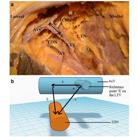 Axillary Dissection In Progress In A Patient With Locally Advanced