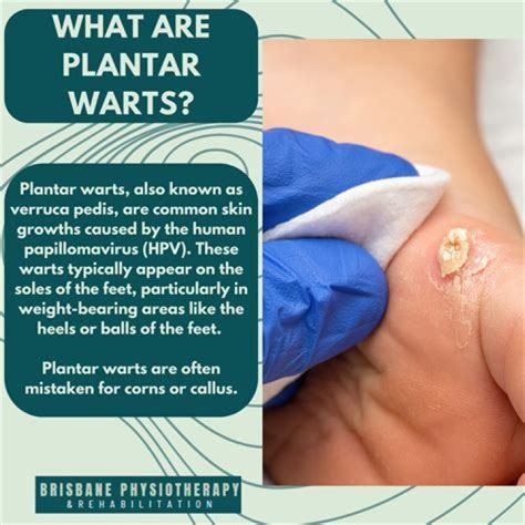What Hpv Causes Warts On Feet The Daily Insight