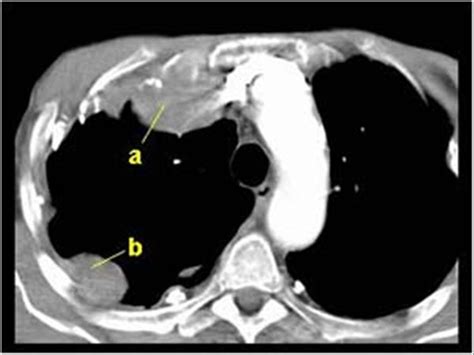 Thorax 82 Pleural Space Case 822 Benign And Malignant Pleural